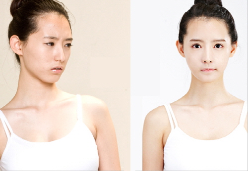 얼굴 작아지는 수술, 망설여지는 이유는?
